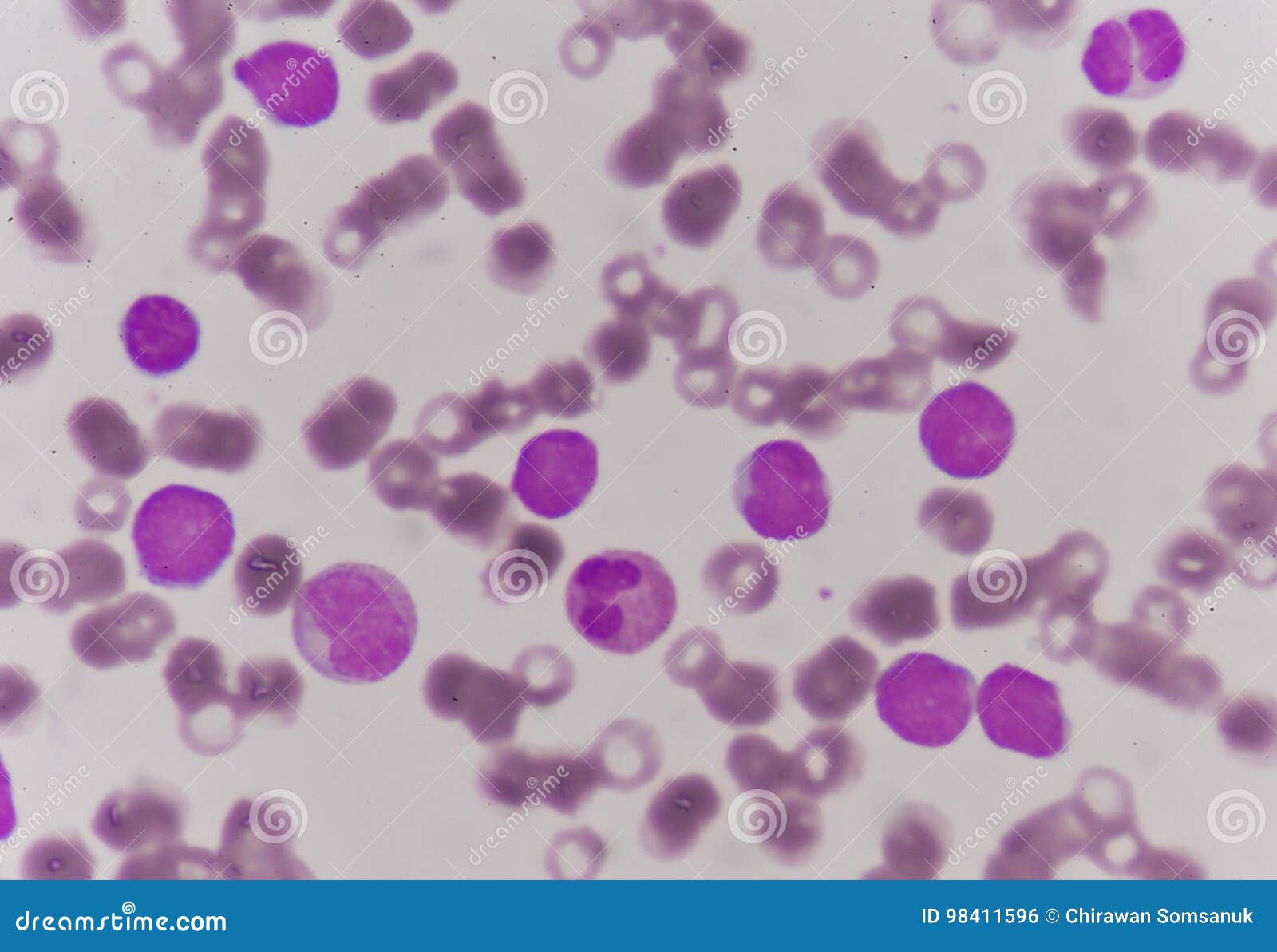 Blast cells in Leukemia stock photo. Image of laboratory - 98411596
