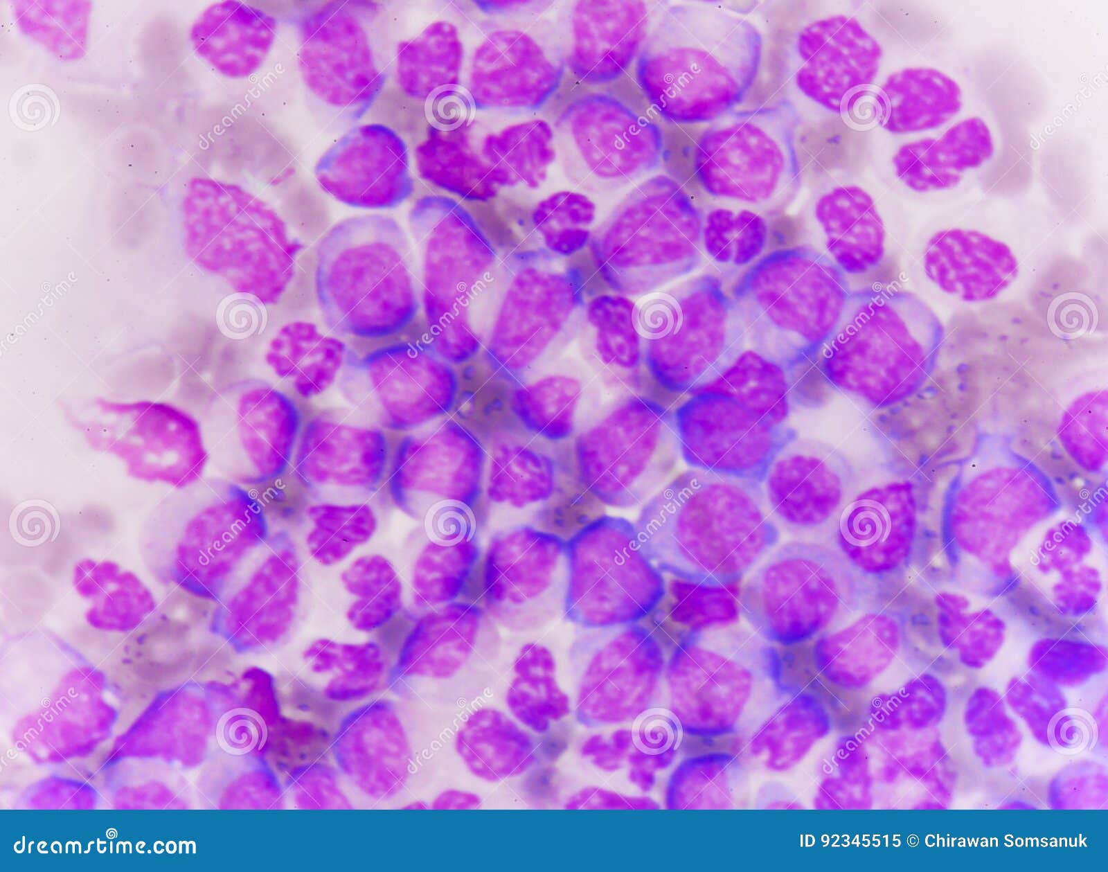 Blast cells in Leukemia stock image. Image of medicine - 92345515