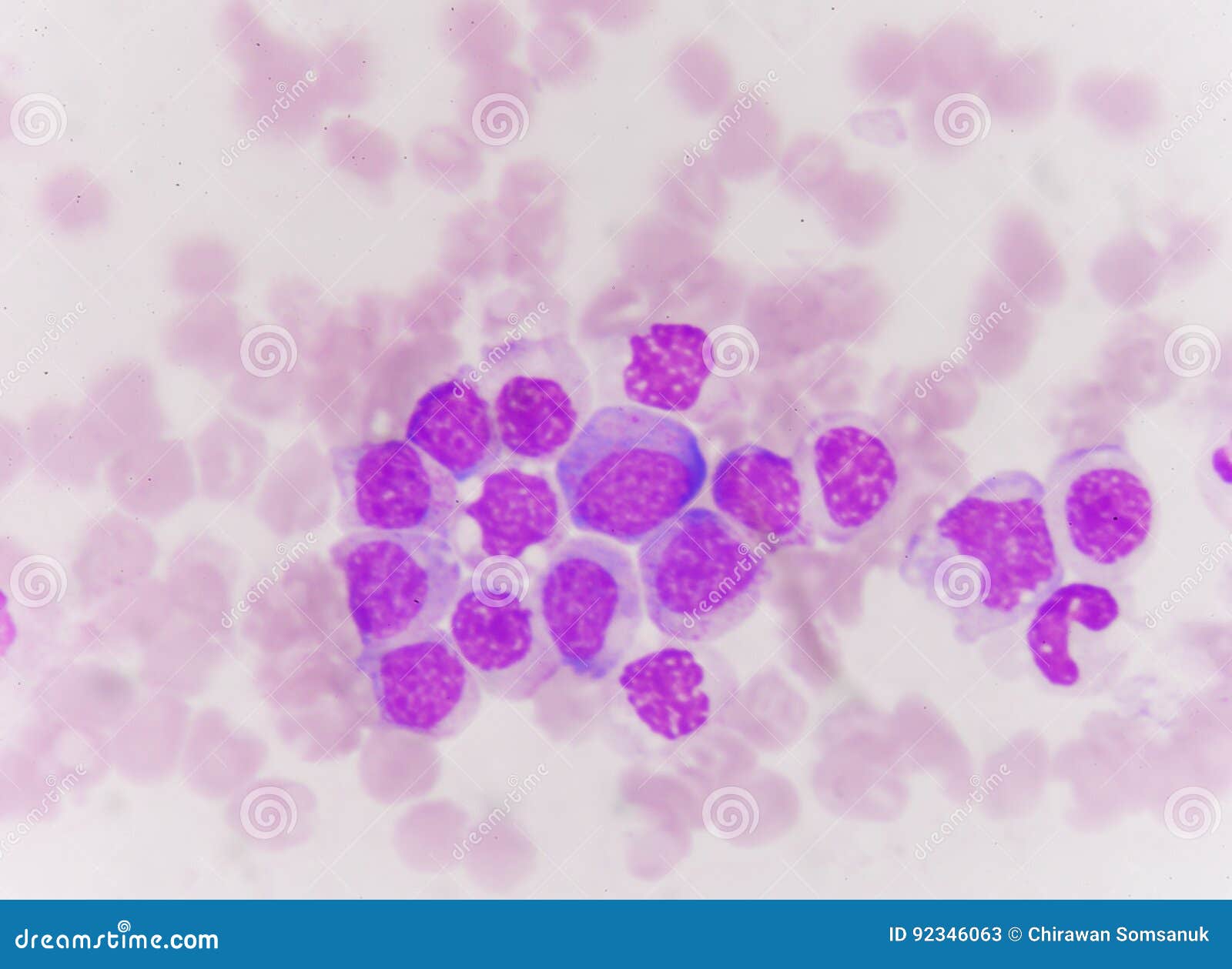 Blast cells in Leukemia stock image. Image of neutrophil - 92346063