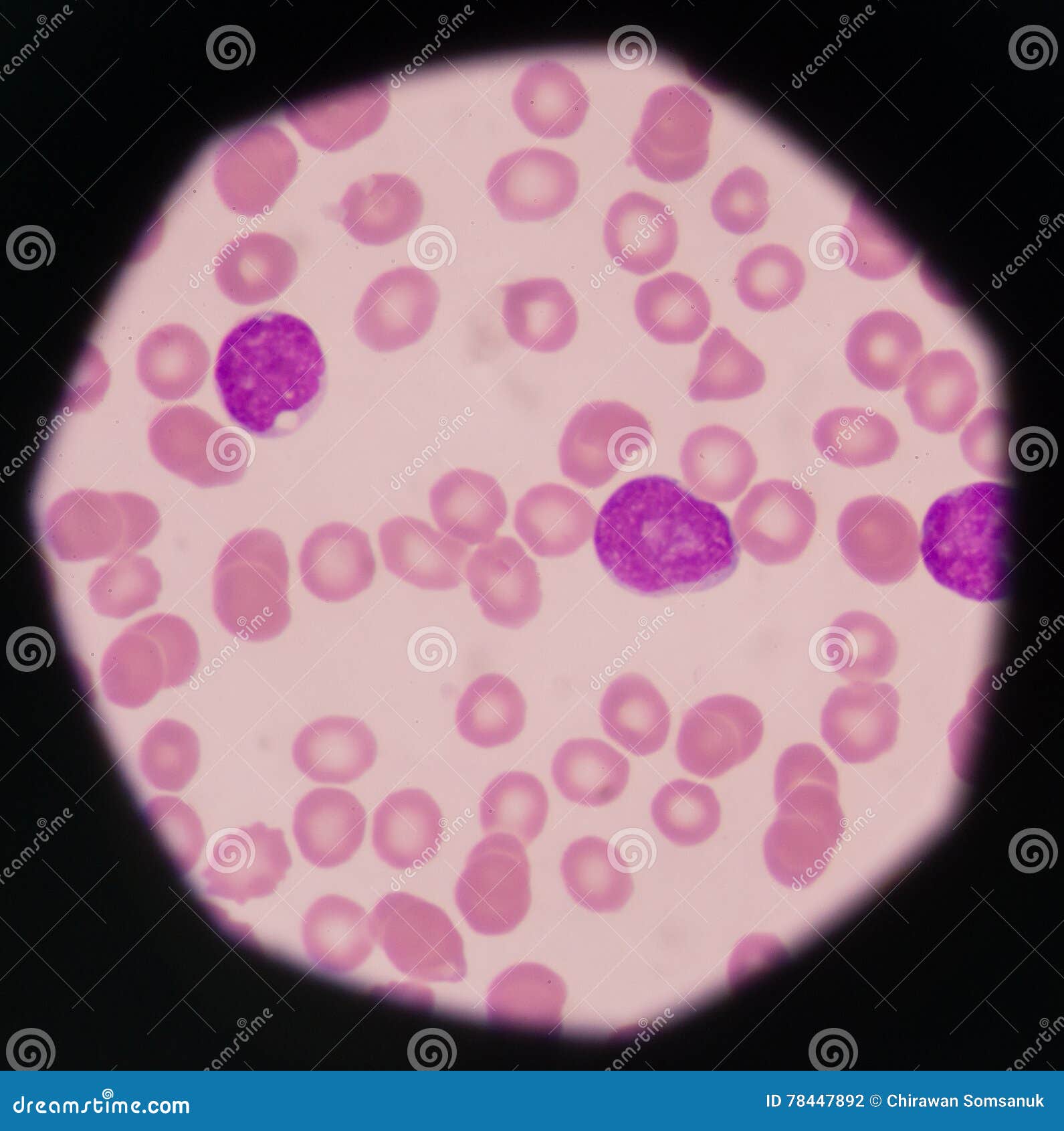 Blast Cells in Peripheral Blood Images. Stock Photo - Image of disease ...