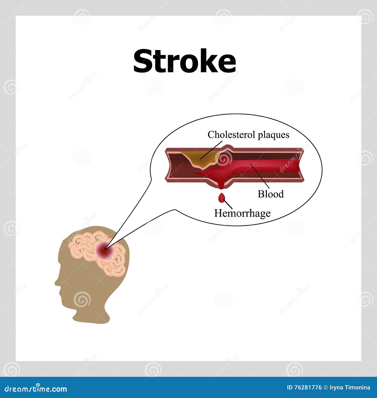 Bleeding in the Brain. Insult. Stroke, Atherosclerosis. Cholesterol ... Bleeding in the Brain. Insult. Stroke, Atherosclerosis. Cholesterol ...