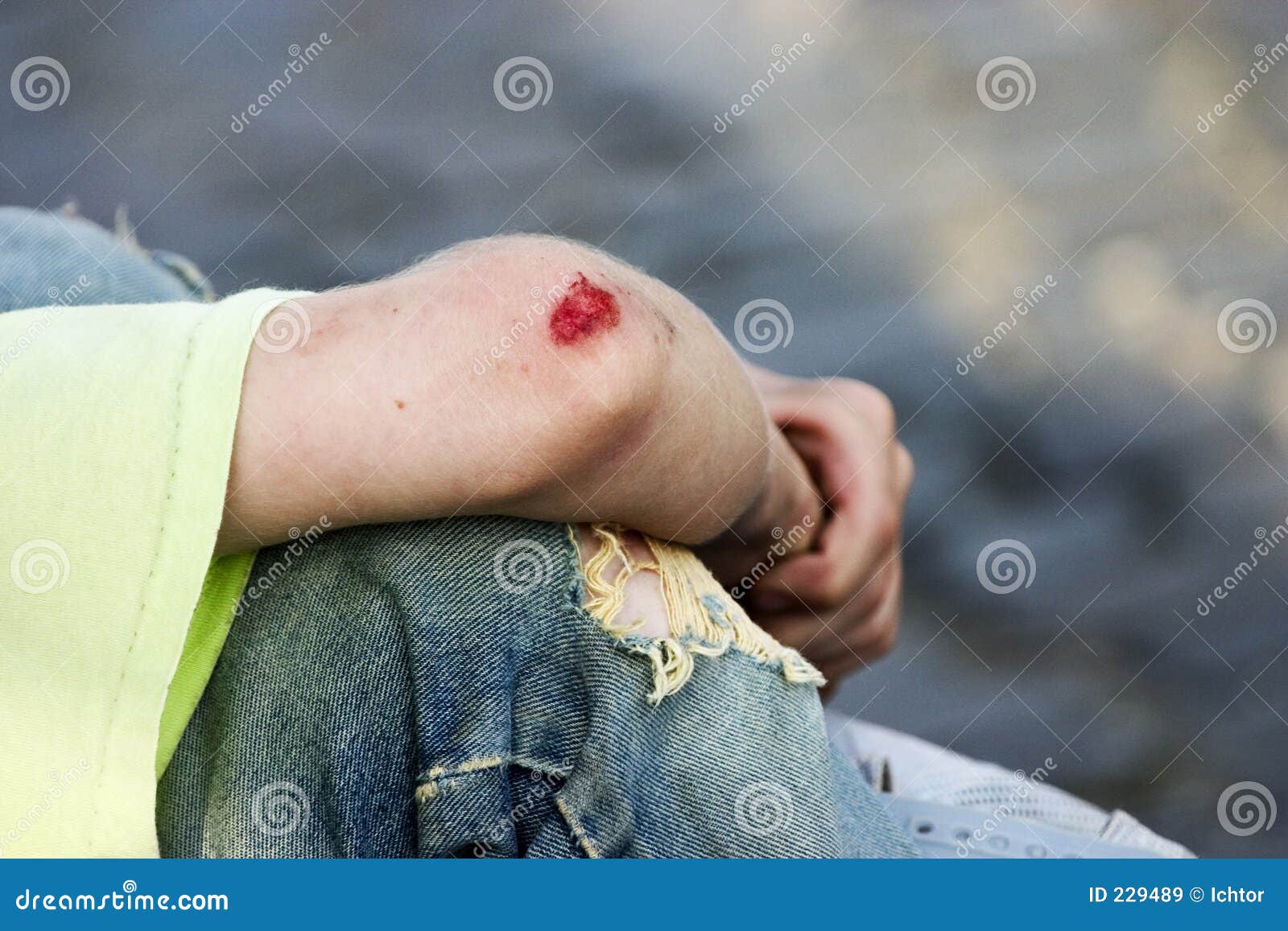 Bleeding Elbow stock image. Image of blue, skin, break - 229489