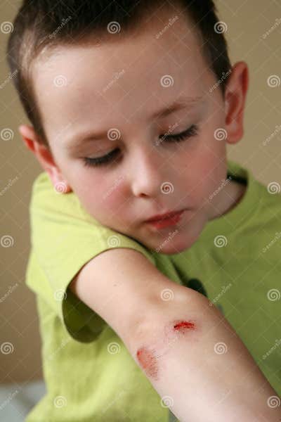 Bleeding injured boy stock photo. Image of scratch, care - 9490900