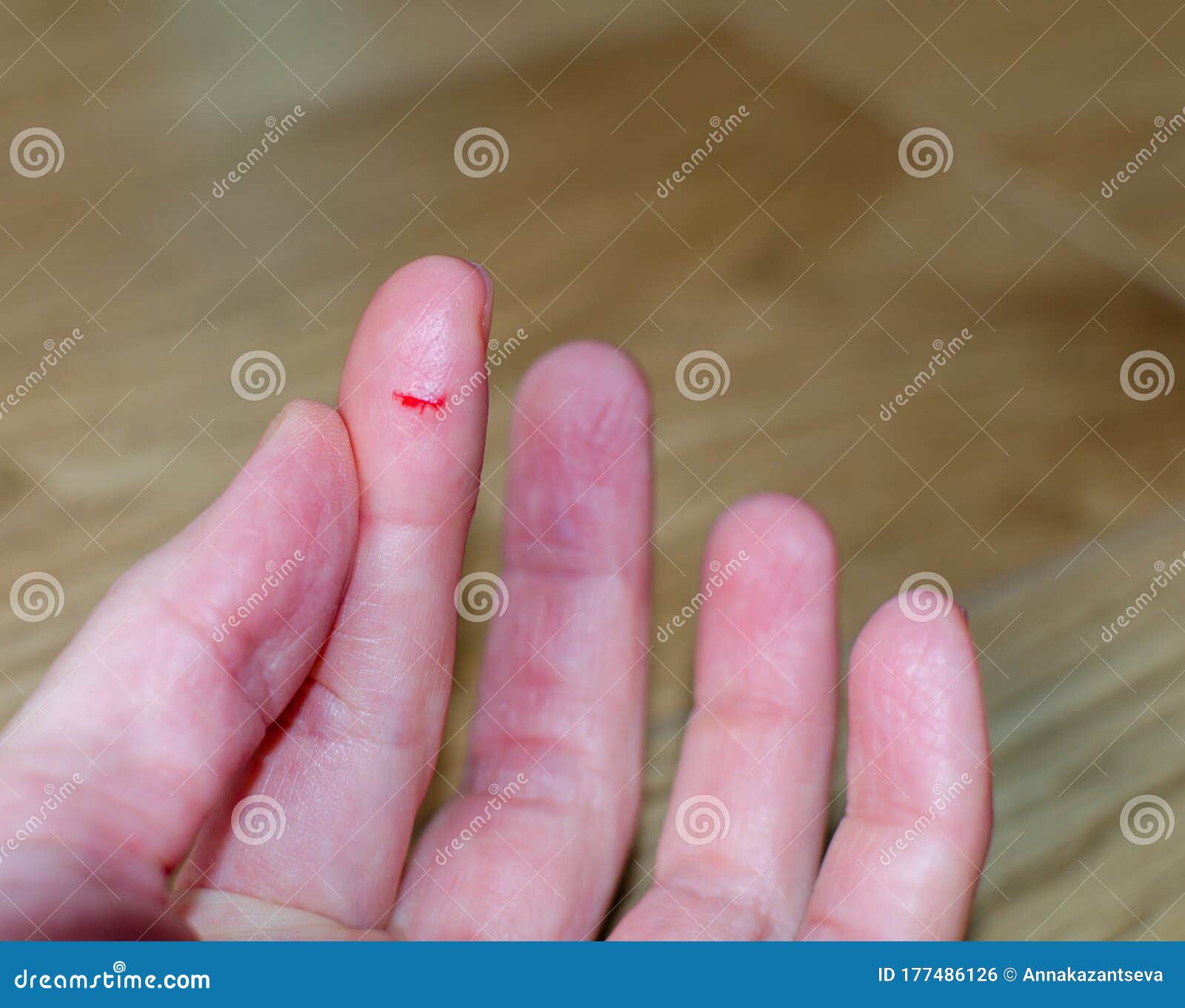 Bleeding from Sharp Cut Wound at Left Index. Finger Cut, Bleeding ...