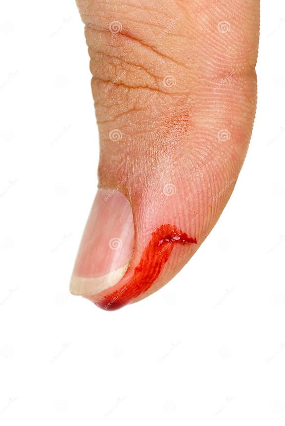 Bleeding thumb finger stock photo. Image of finger, sore - 15006988