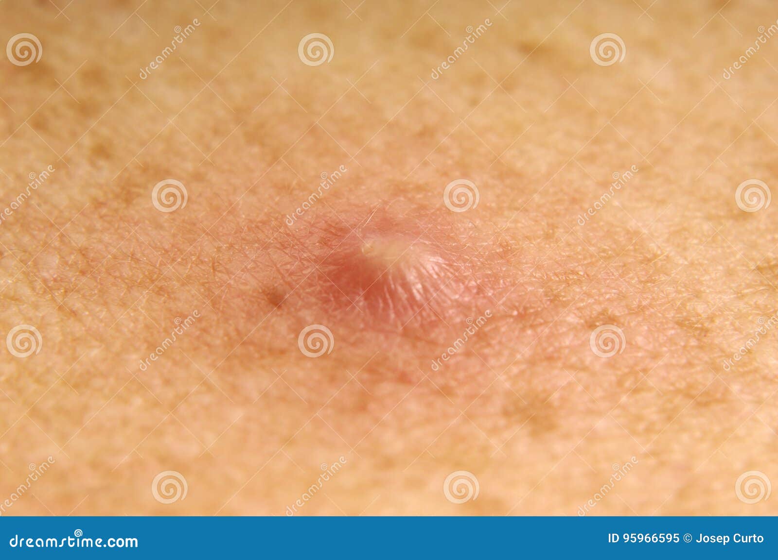 Blemish of pus stock image. Image of healthcare, cystic - 95966595
