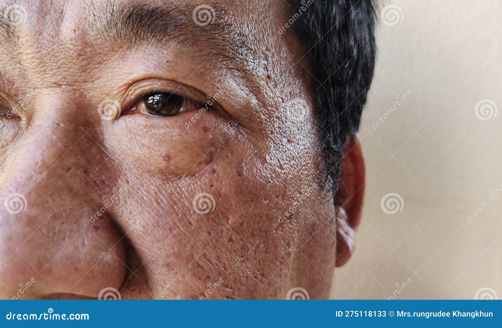The Blemishes Freckles and Dark Spots on the Face Stock Image - Image ...
