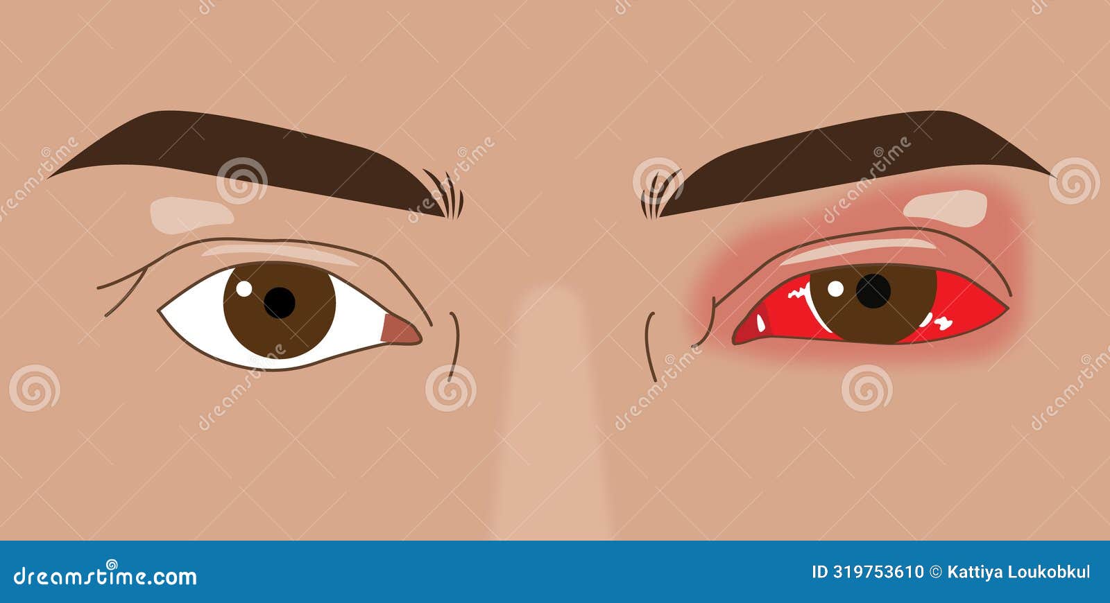 Blepharitis or Conjunctivitis Red Eye, Close-up Illustration Stock ...
