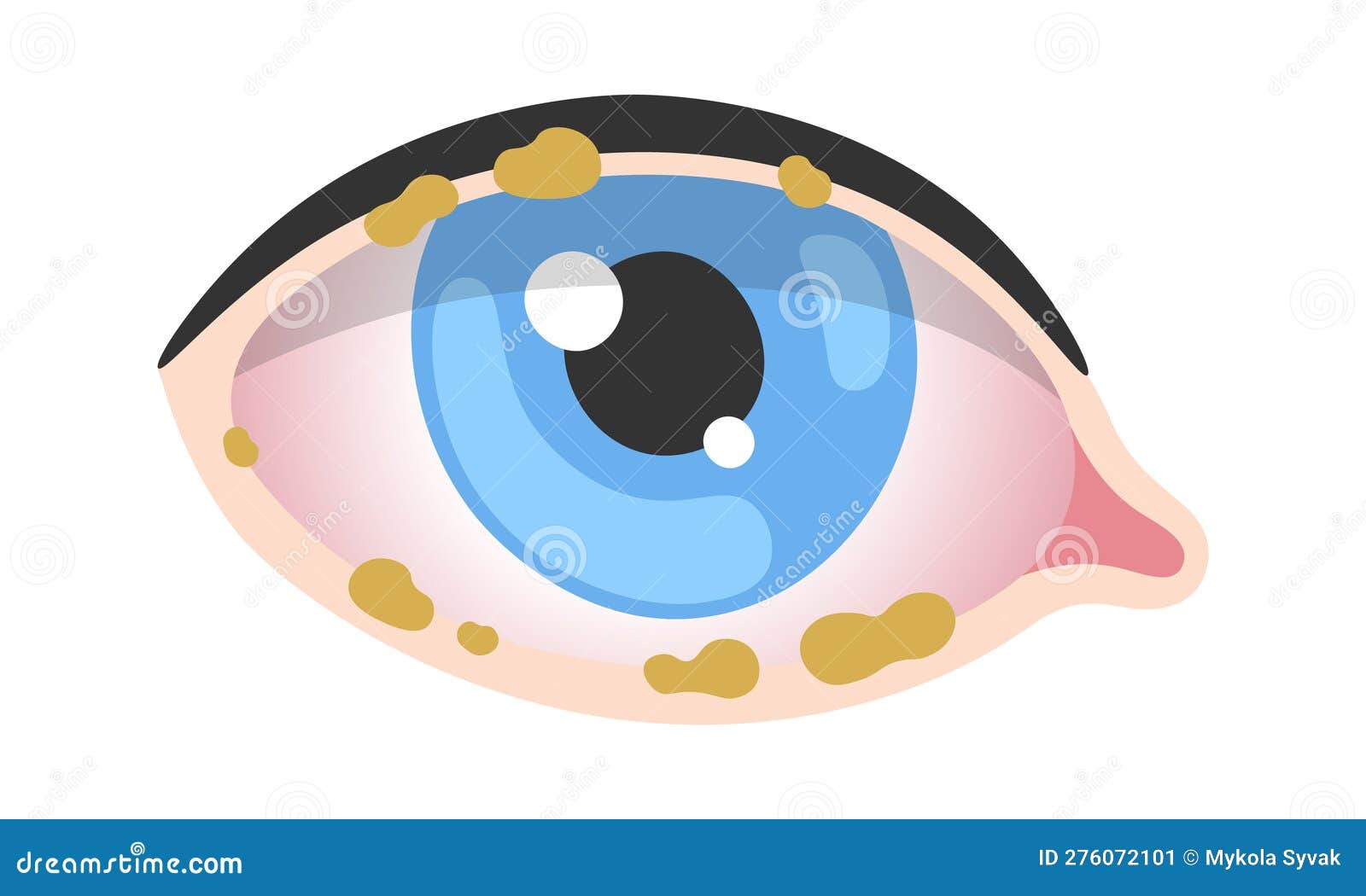Blepharitis Human Eye Disease Stock Vector - Illustration of vector ...