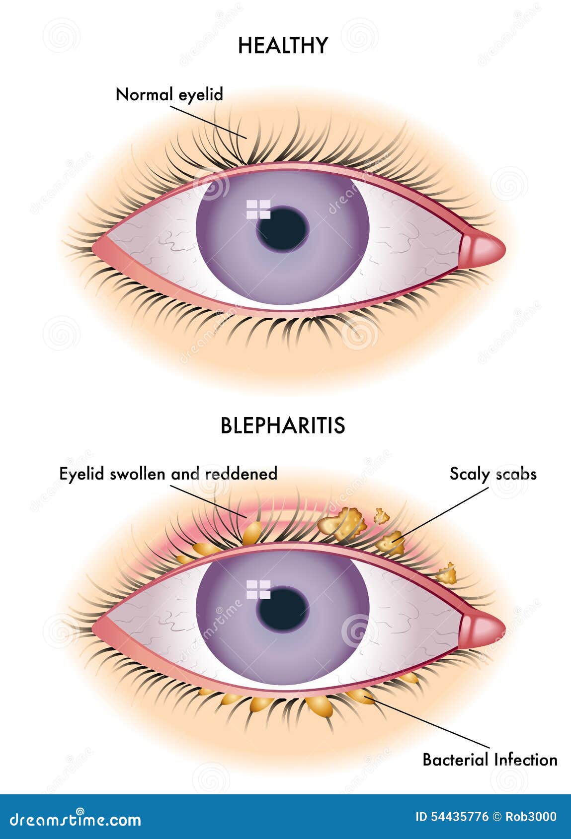 Blepharitis Is An Inflammation Of The Margins Of The Eyelids. Symptoms ...