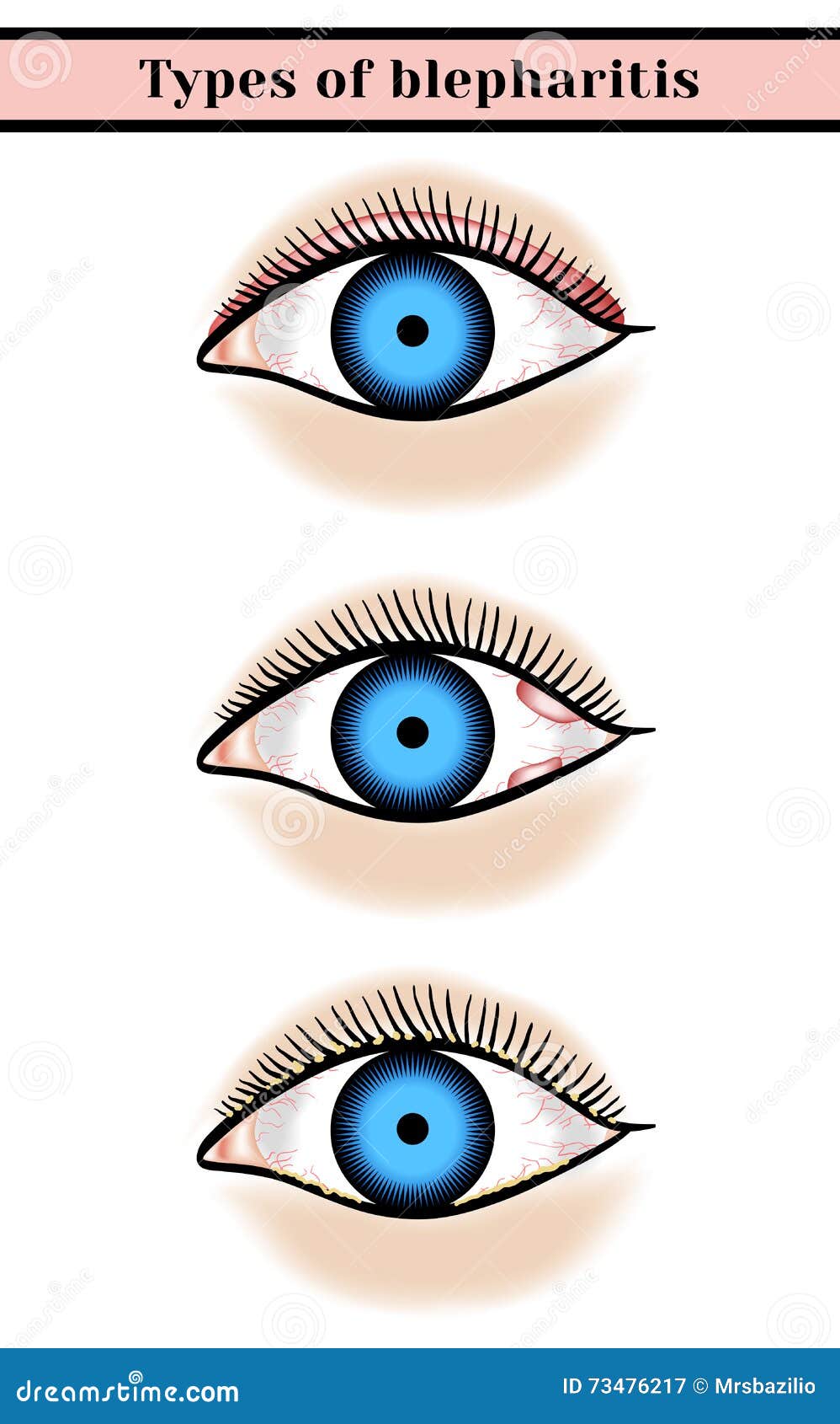 Blepharitis. Purulent, Inflammatory Eyes Disease Cartoon Vector ...