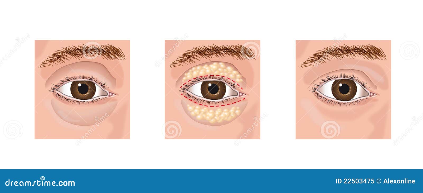 Blepharoplasty Cartoons, Illustrations & Vector Stock Images - 621 ...