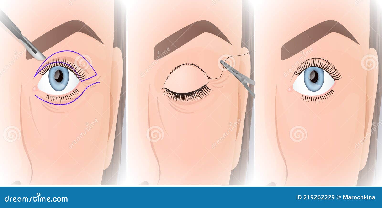 Blepharoplasty Procedure, Plastic Surgery of the Upper Eyelid Stock ...