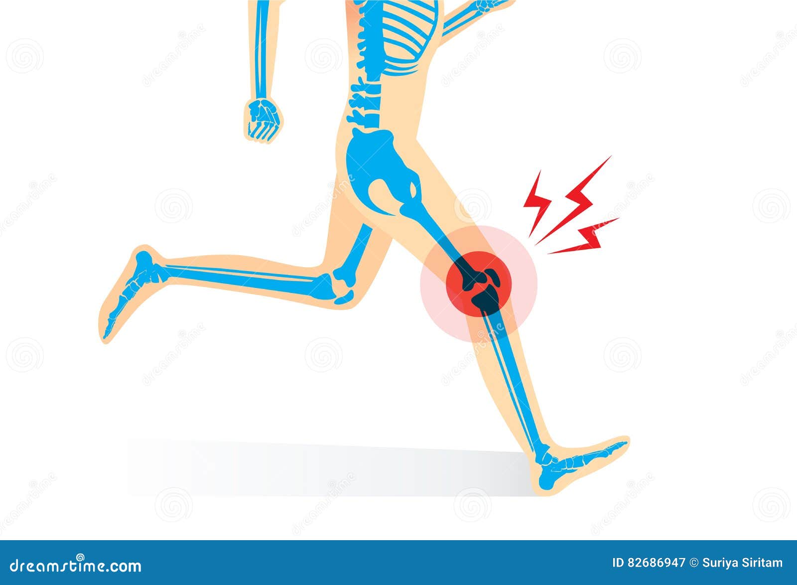 Blessure D'os Et De Jambe De Genou Tout En Courant Illustration de ...