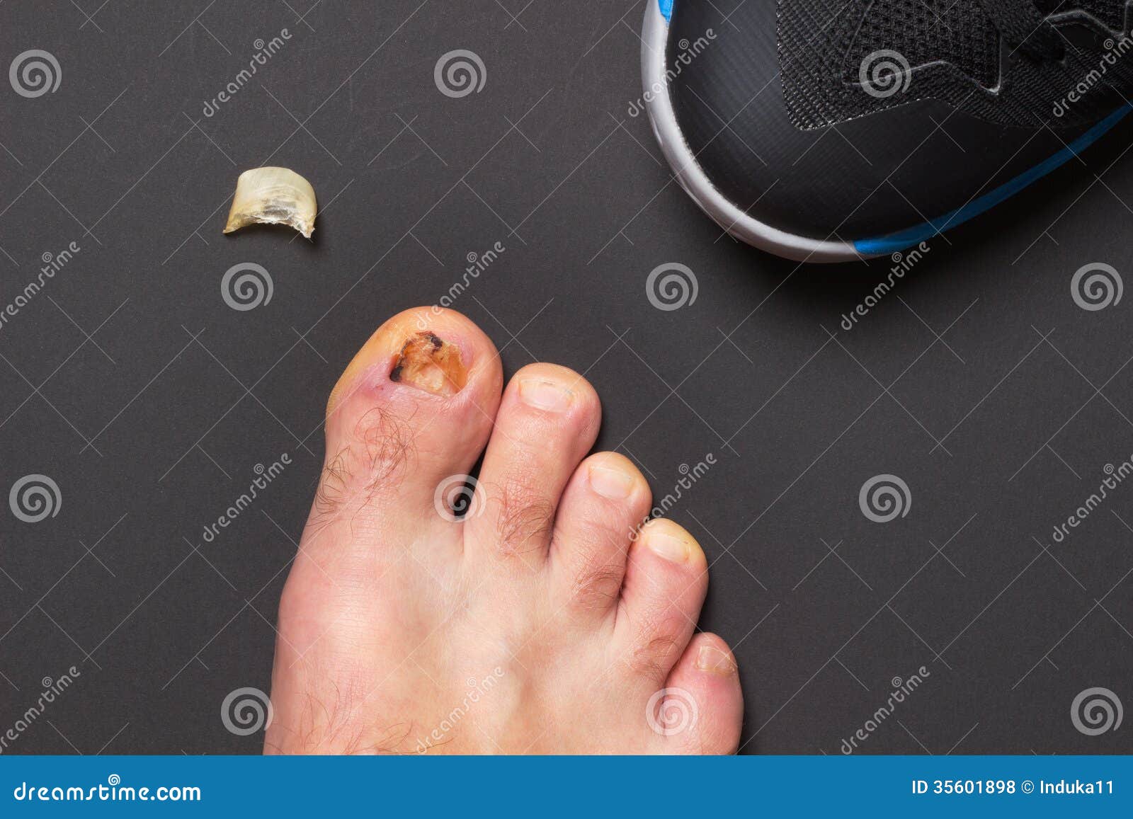 Blessure de clou photo stock. Image du infection, douloureux - 35601898