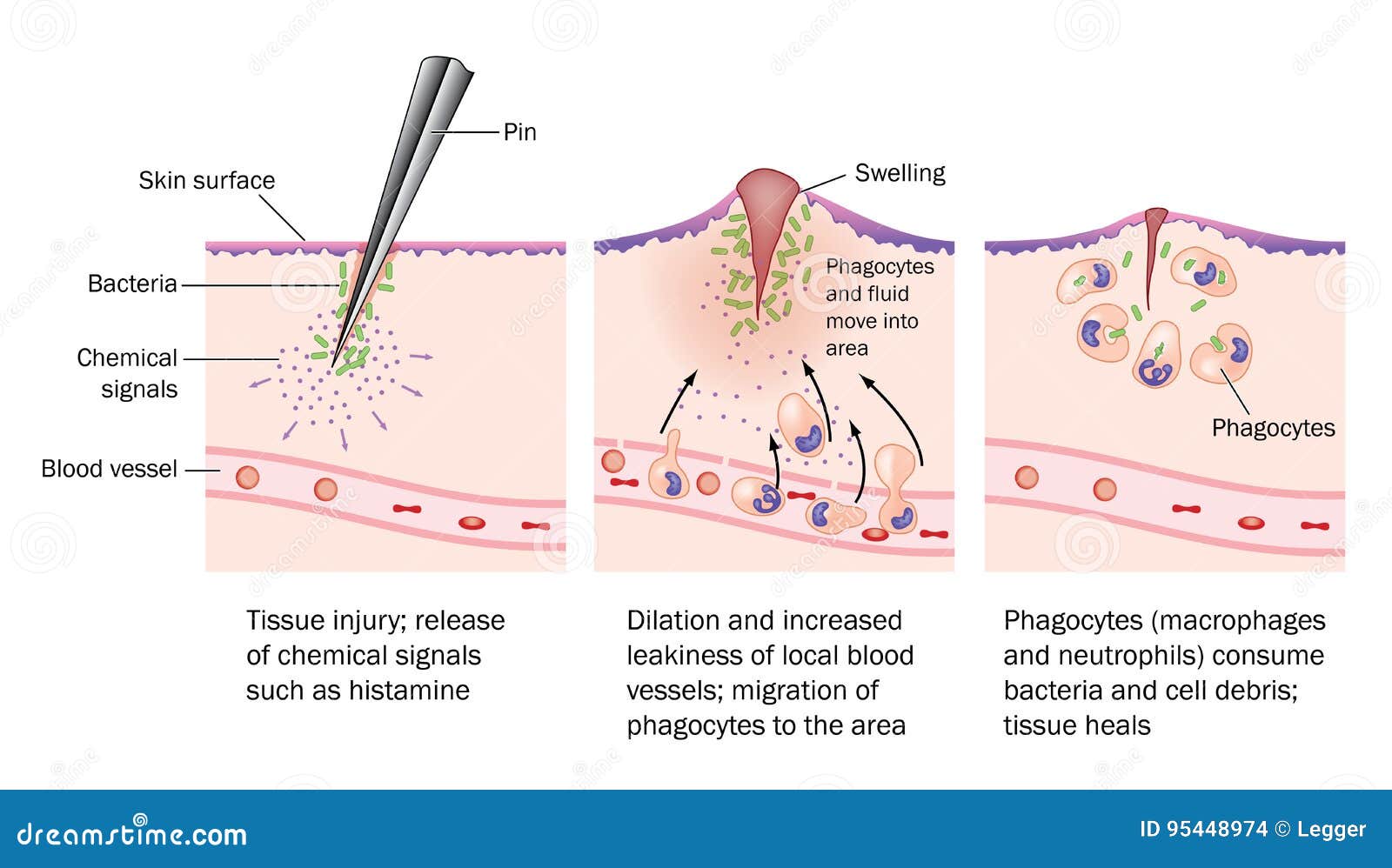 Blessure et inflammation illustration de vecteur. Illustration du ...