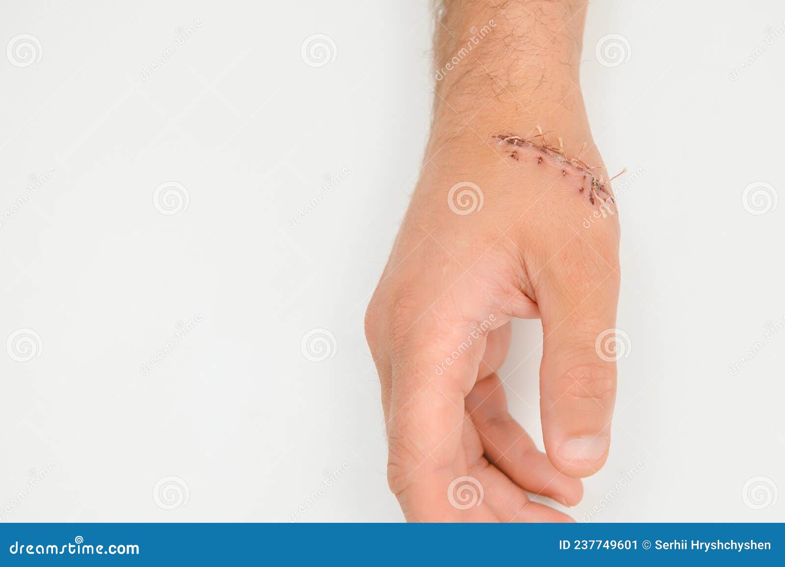 Blessure Suture En Main Douleur Du Concept D'accident Image stock ...