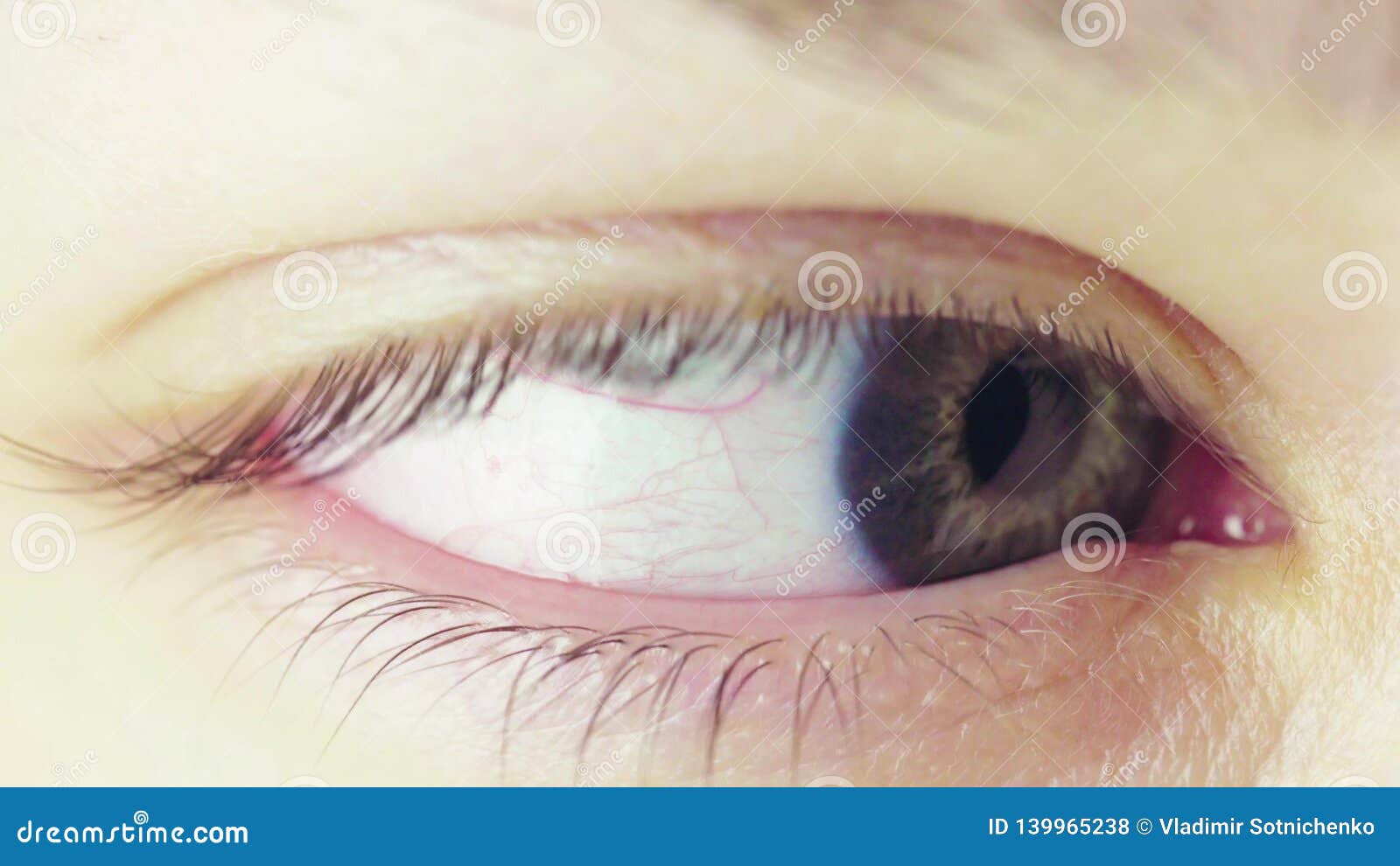 Blinking Human Eye. Constriction of the Iris in Bright Light Stock ...
