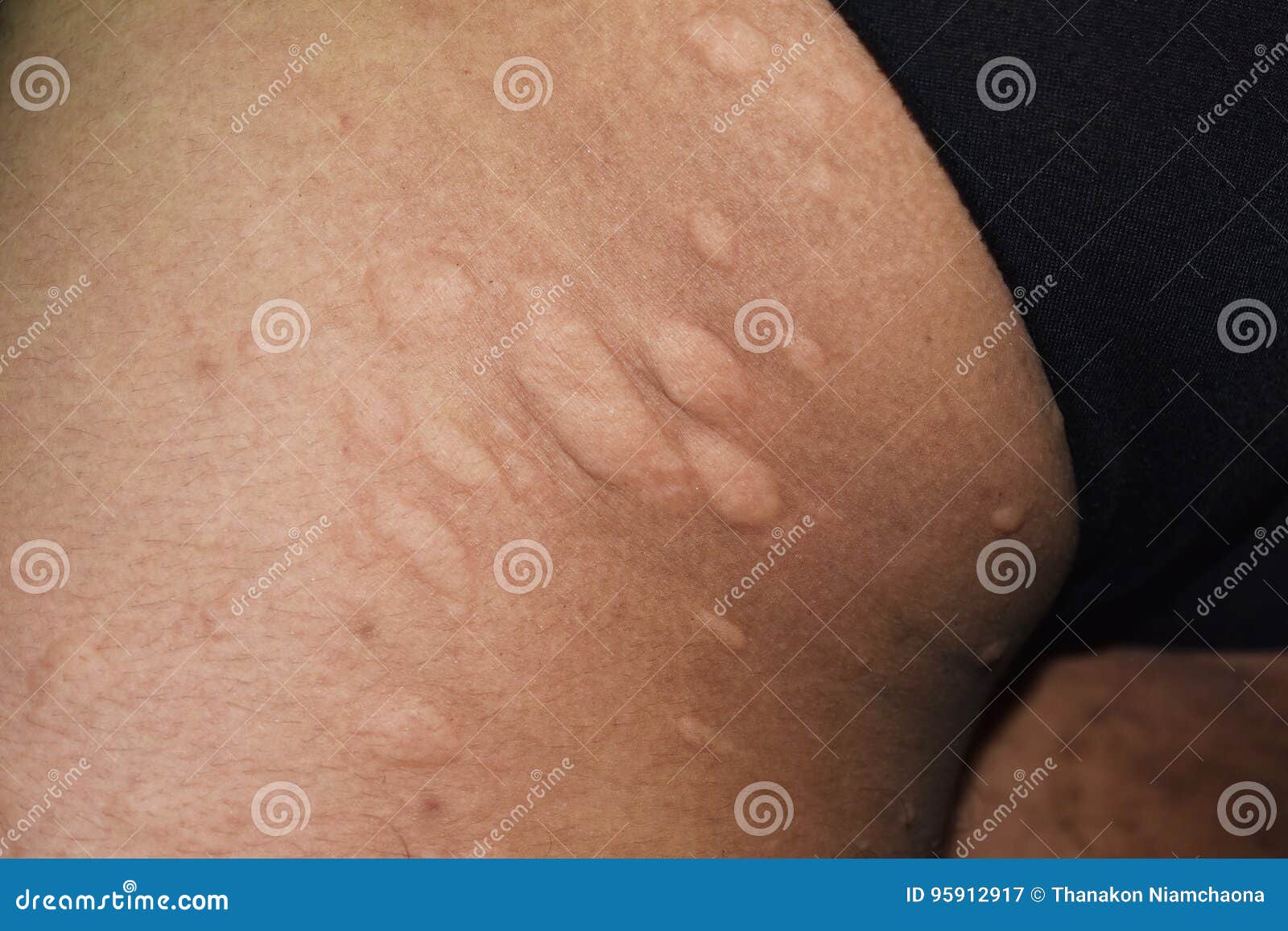 Blister after Ant Bite on Thigh Skin Stock Image - Image of male ...