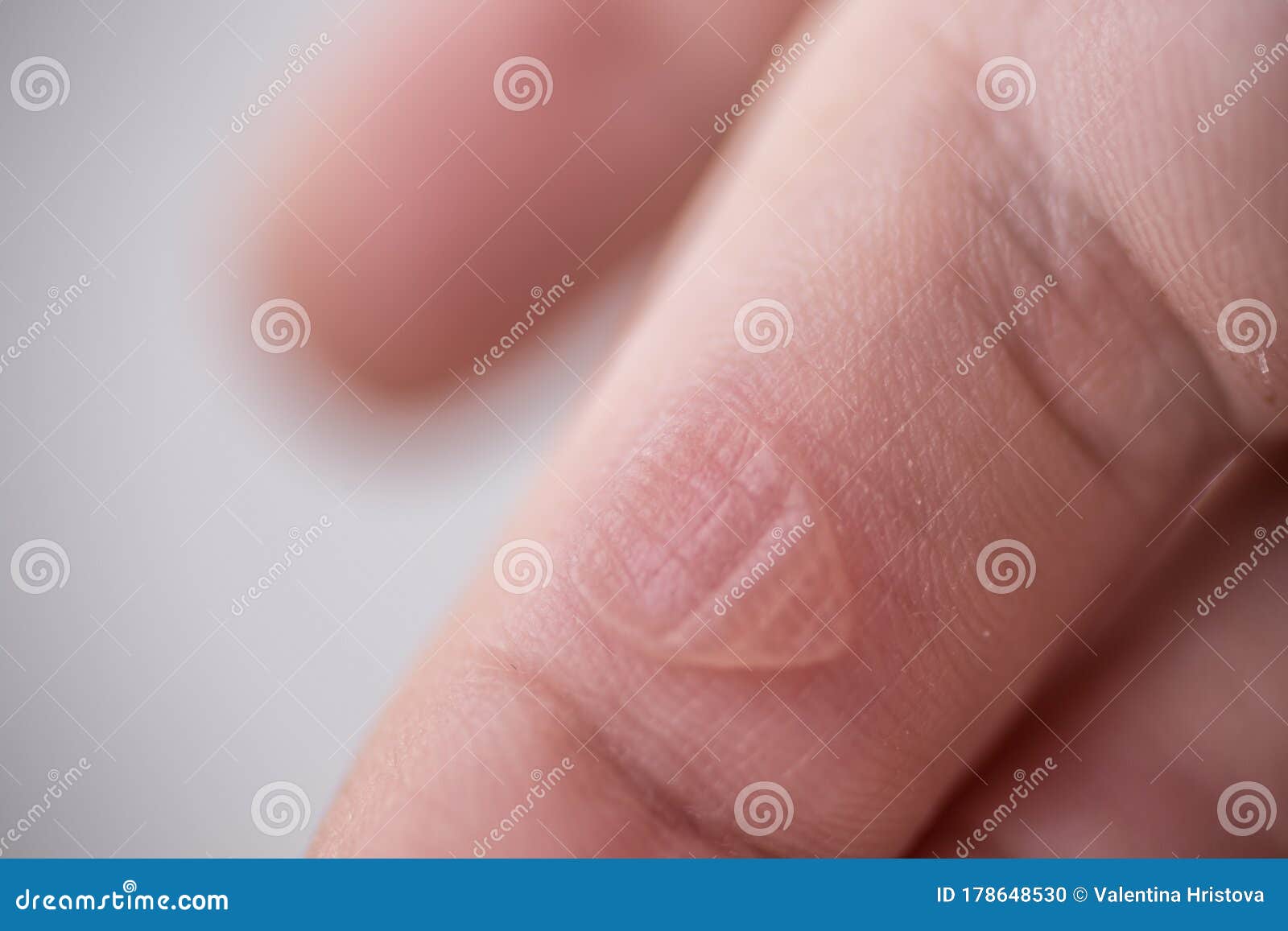 Blister On Finger From Cryotherapy Royalty-Free Stock Image ...