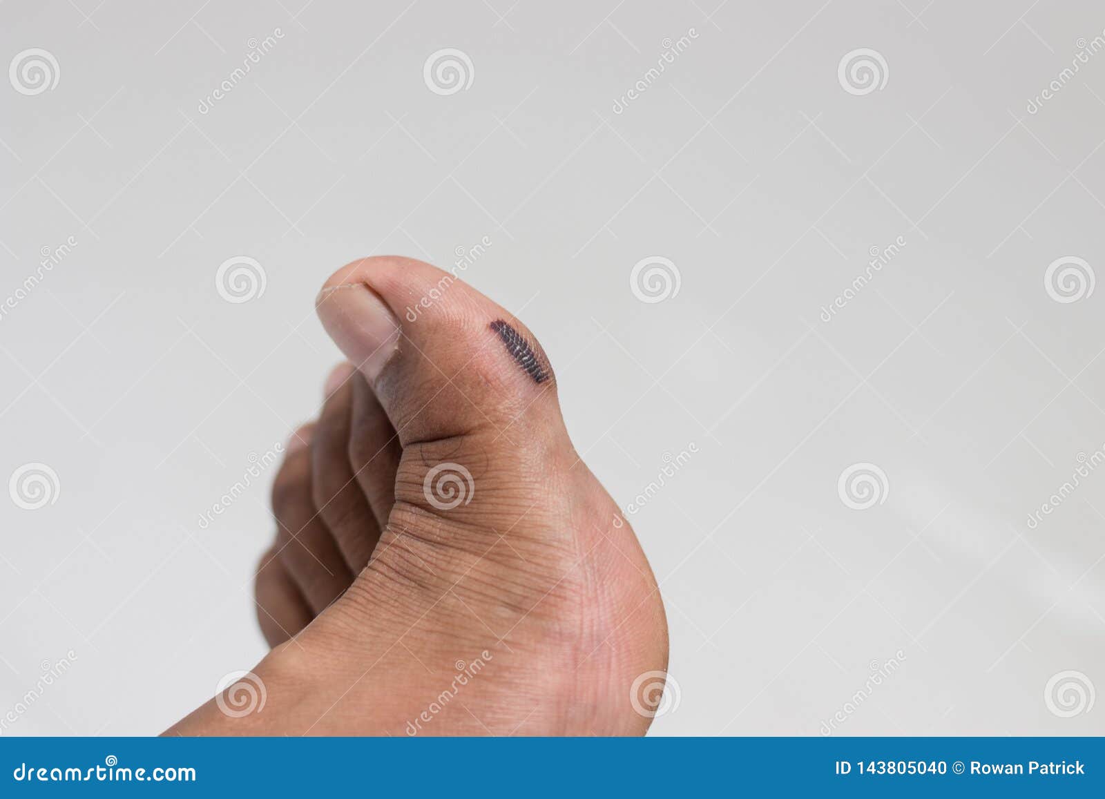 Internal Bleeding Hand