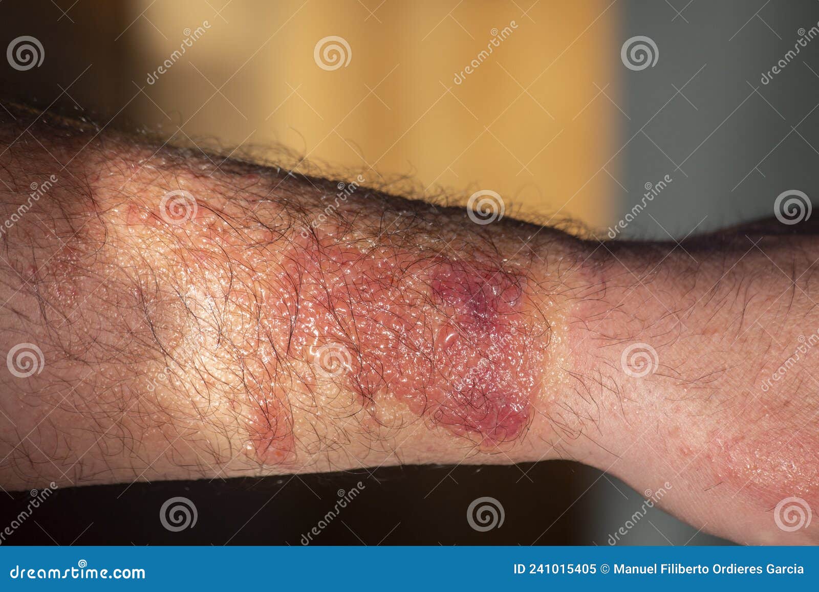 Blistering of the Forearm Due To a Phytophotodermatitis Reaction Caused ...