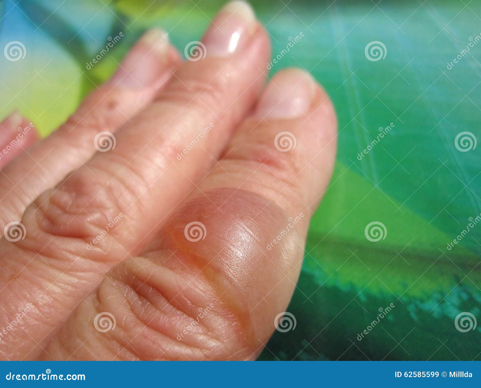 Blisters on the Burnt Finger Stock Image - Image of burn, pain: 62585599