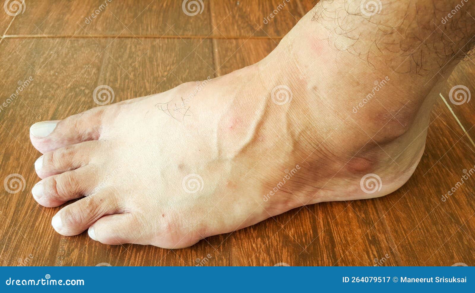 Blisters on a Legs after Ant Bite Solenopsis Geminata ,tropical Fire ...