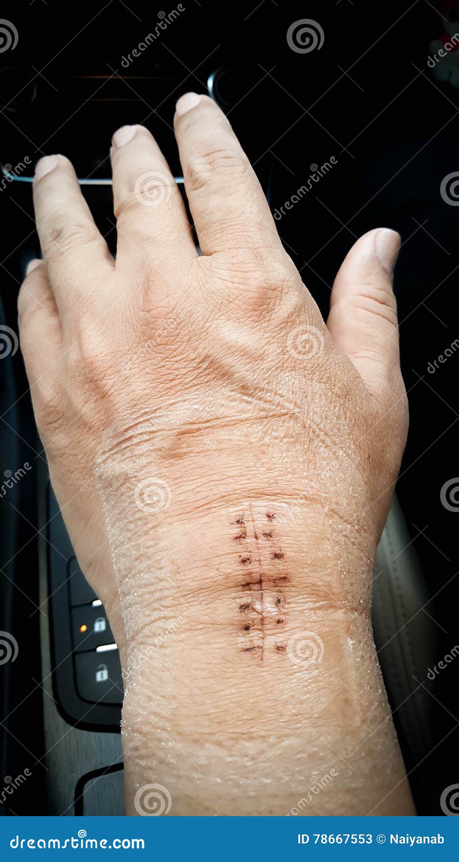 Blisters Scab on Stitched Wound on Man Hand Stock Image - Image of ...