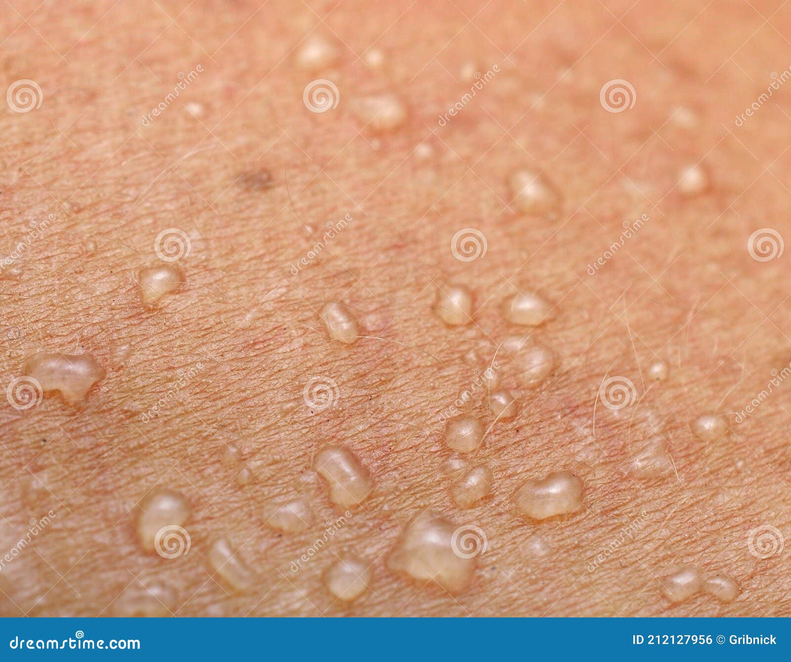 A blisters on the skin stock photo. Image of problems - 212127956