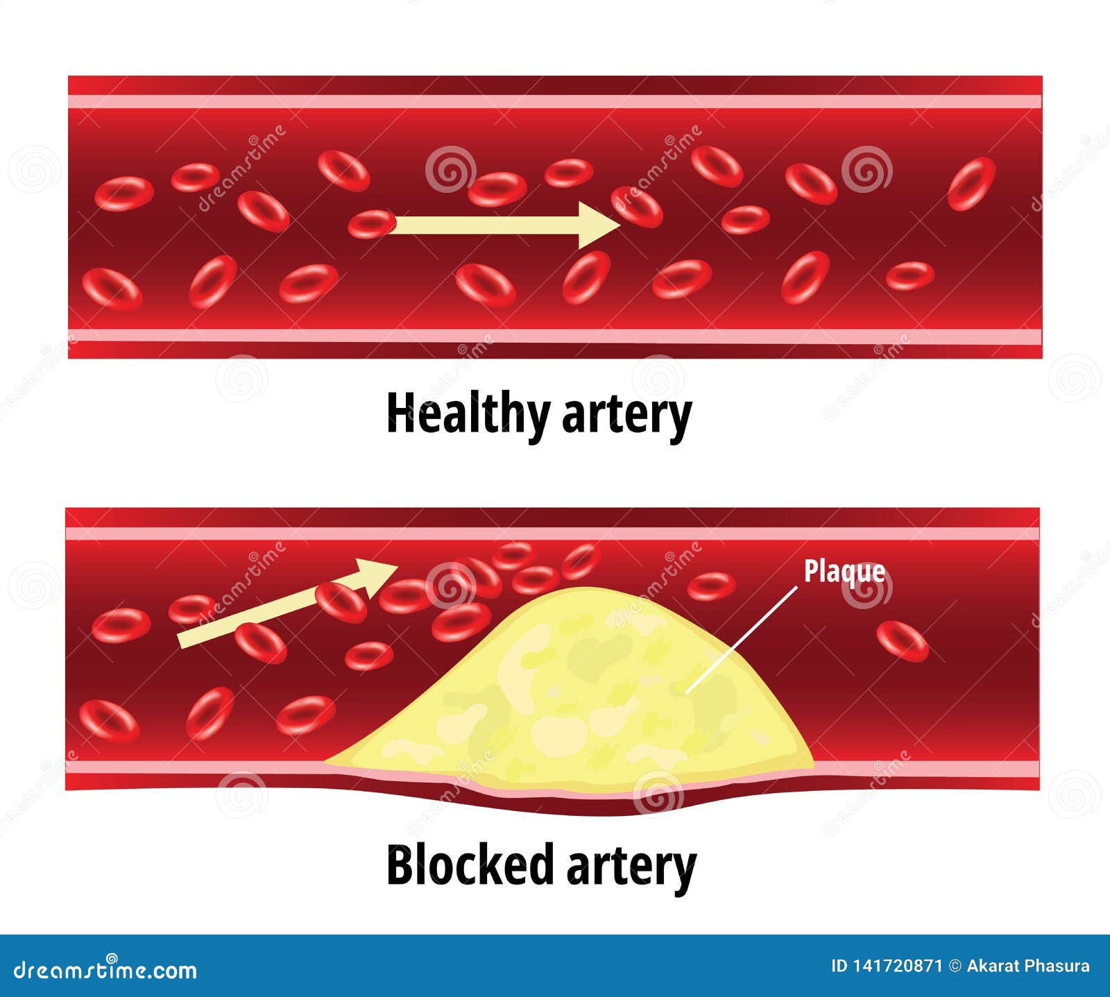 Blocked Artery, Fat Stuck in the Blood Artery, Cholesterol Stock Vector ...