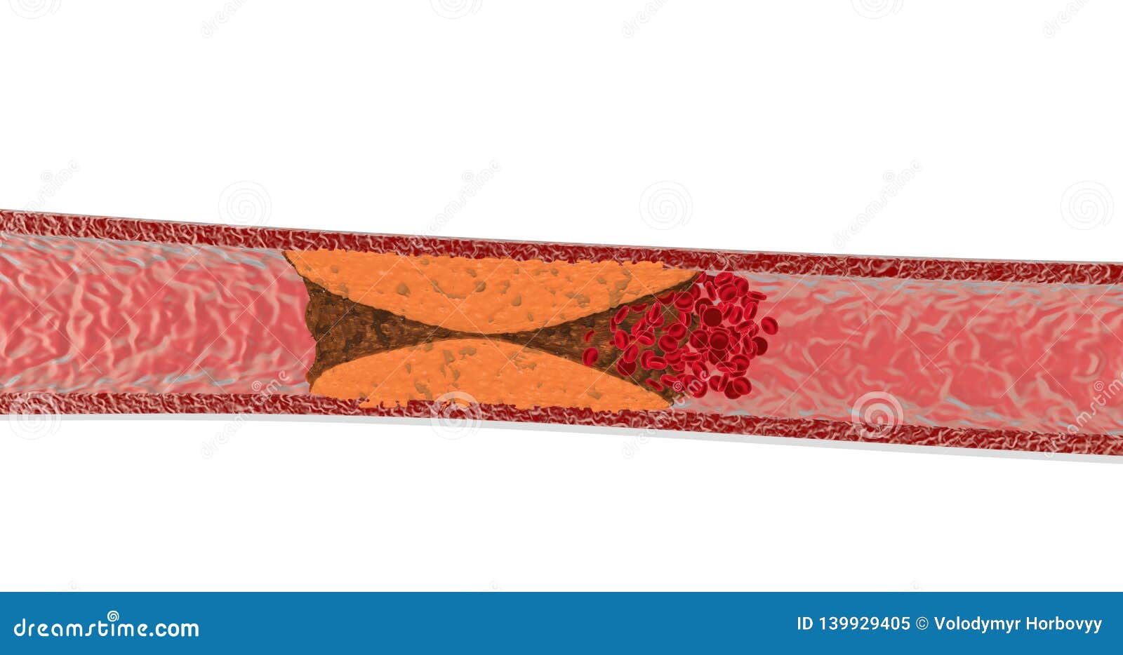 Blocked Blood Vessel 3D Render Stock Illustration - Illustration of ...