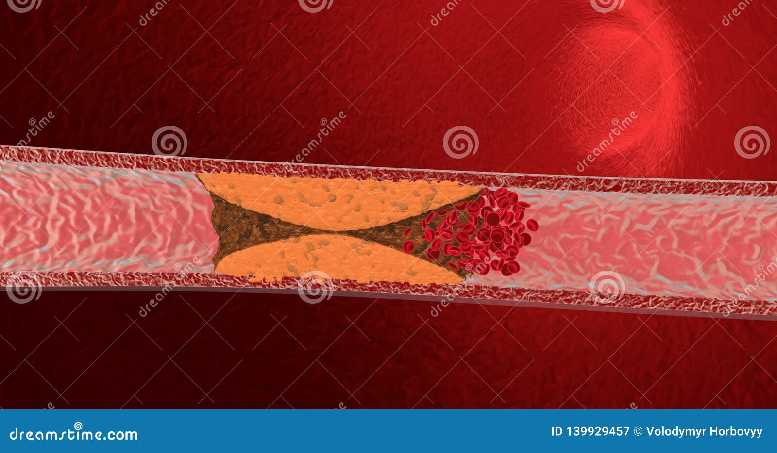 Blocked Blood Vessel 3D Render Stock Illustration - Illustration of ...