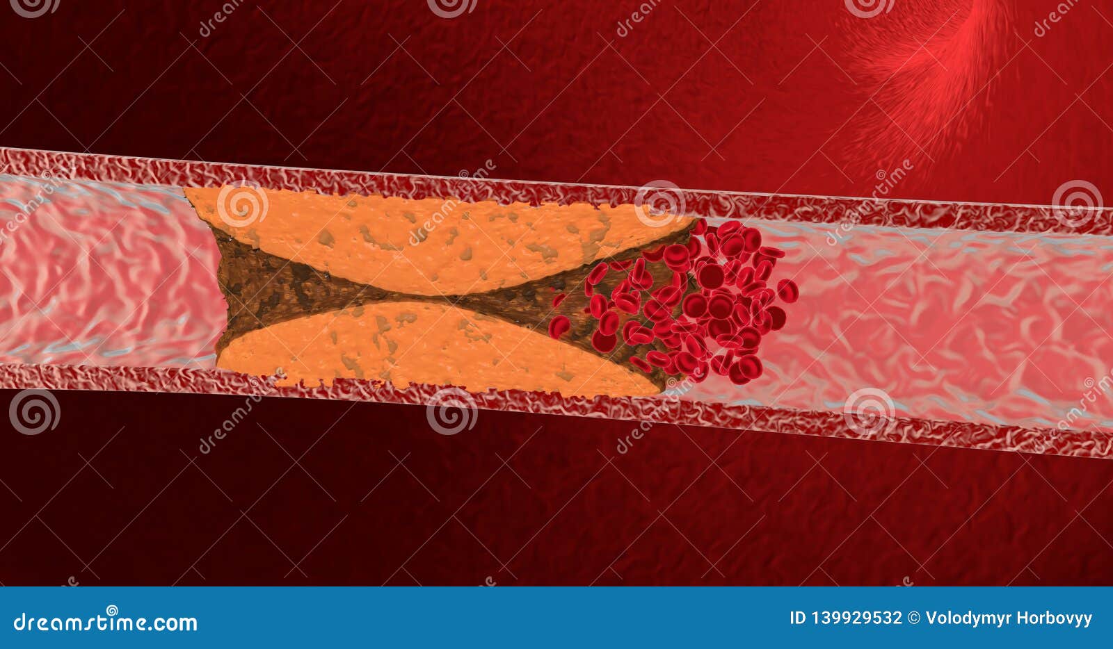 Blocked Blood Vessel 3D Render Stock Illustration - Illustration of ...