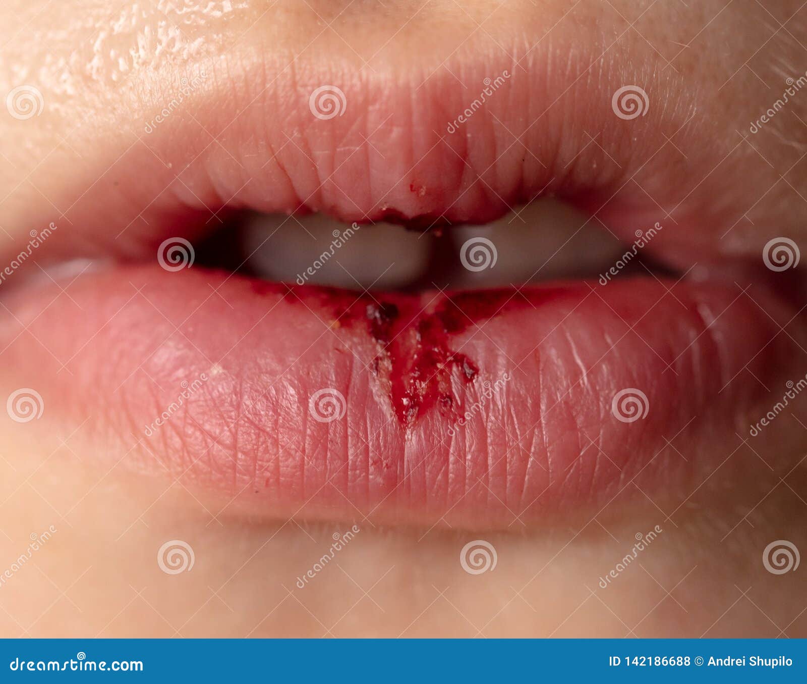 Blood on the boy`s lip stock photo. Image of disease - 142186688