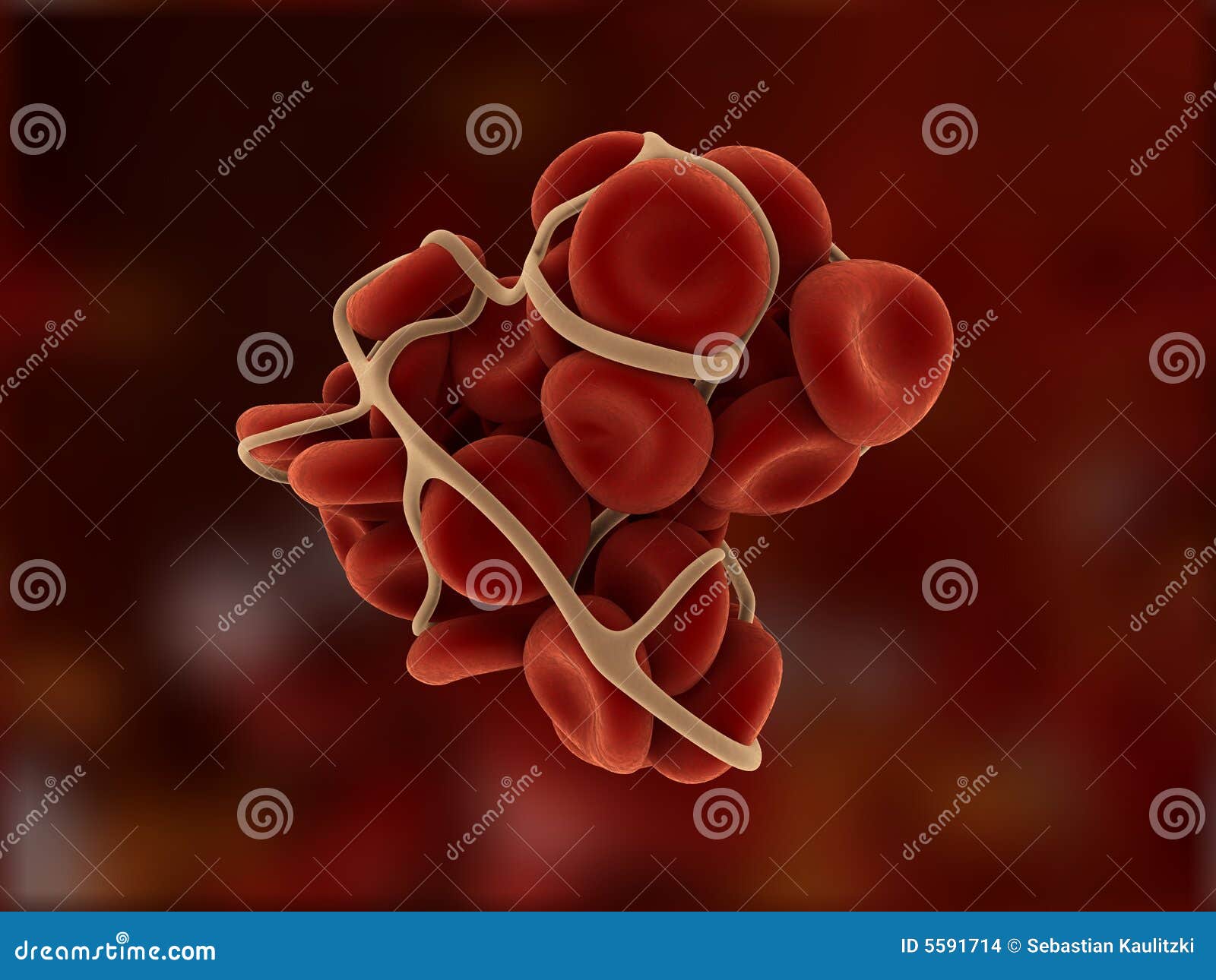 Blood Clot. Thrombus. Red Blood Cells Bound By Fibrin Filaments. Stock ...