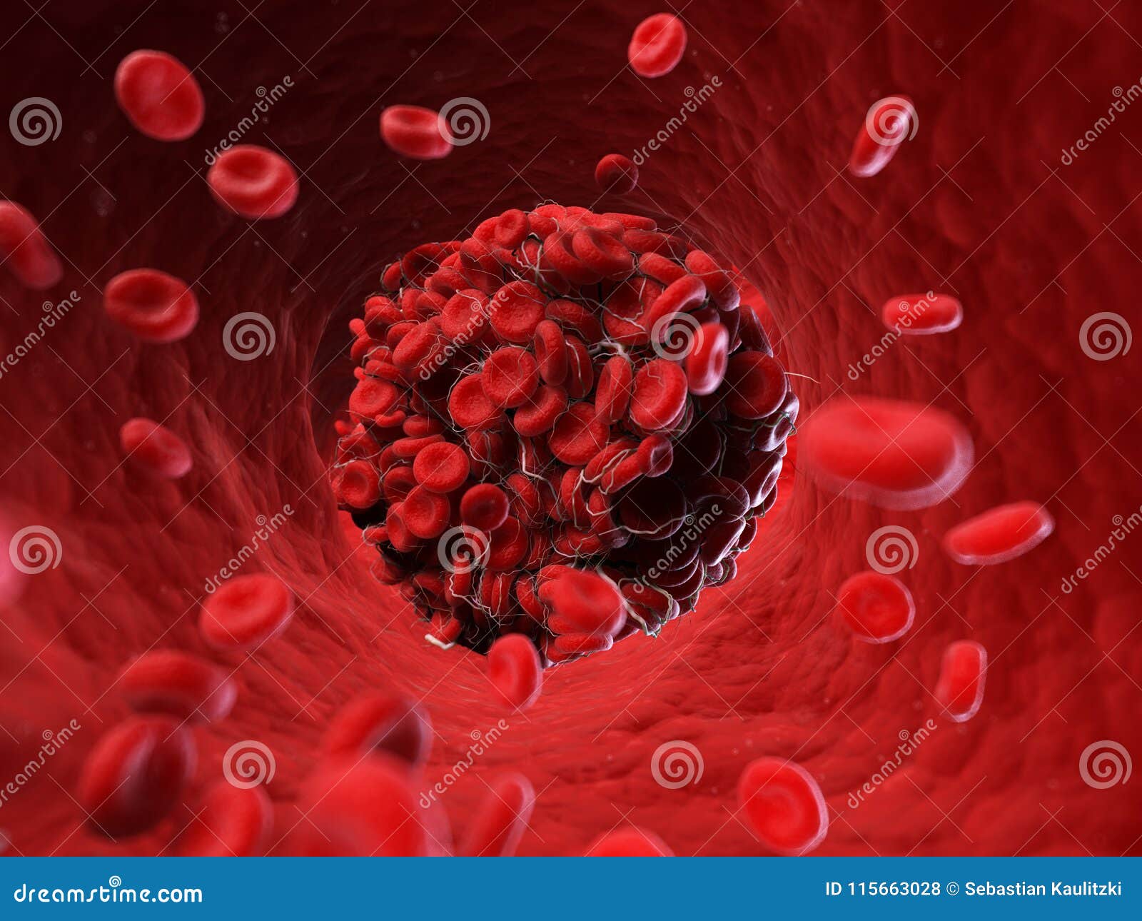 A Blood Clot Royalty-Free Cartoon | CartoonDealer.com #115663028