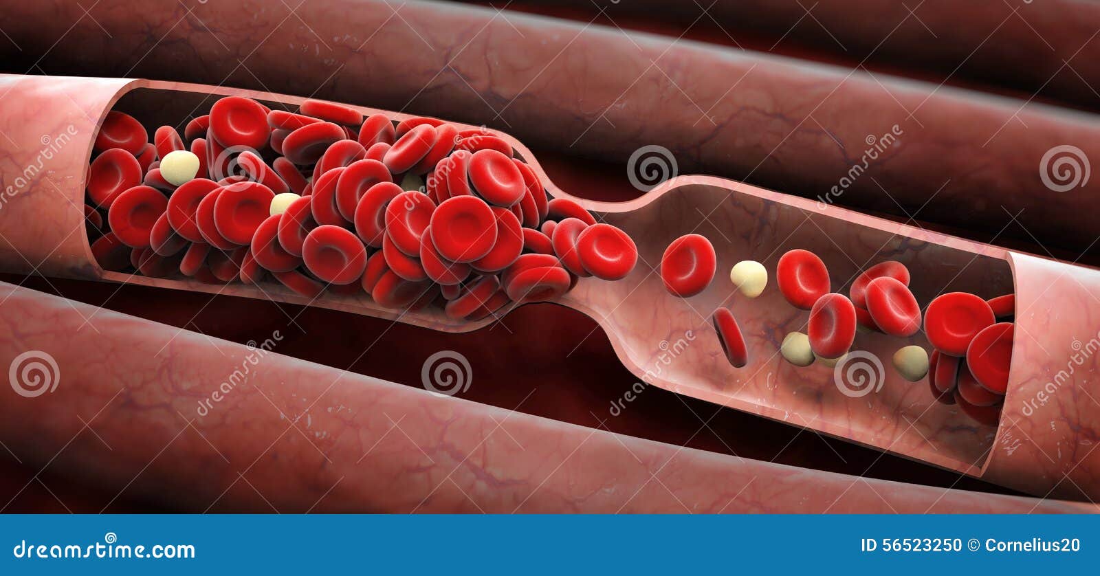 1,366 Blood Clot Cartton Stock Photos - Free & Royalty-Free Stock ...