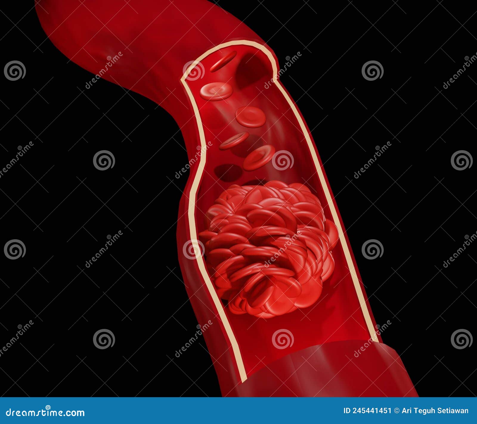 Blood Clot or Thrombus is the Final Product of the Blood Coagulation ...