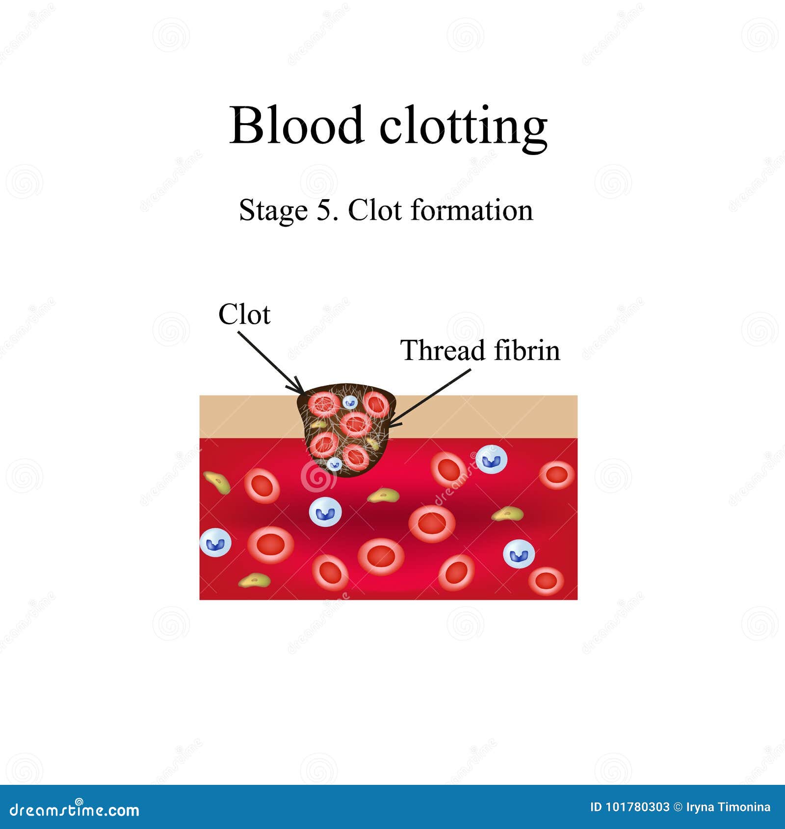Blood Clotting. 5 Stage. Infographics. Vector Illustration ...