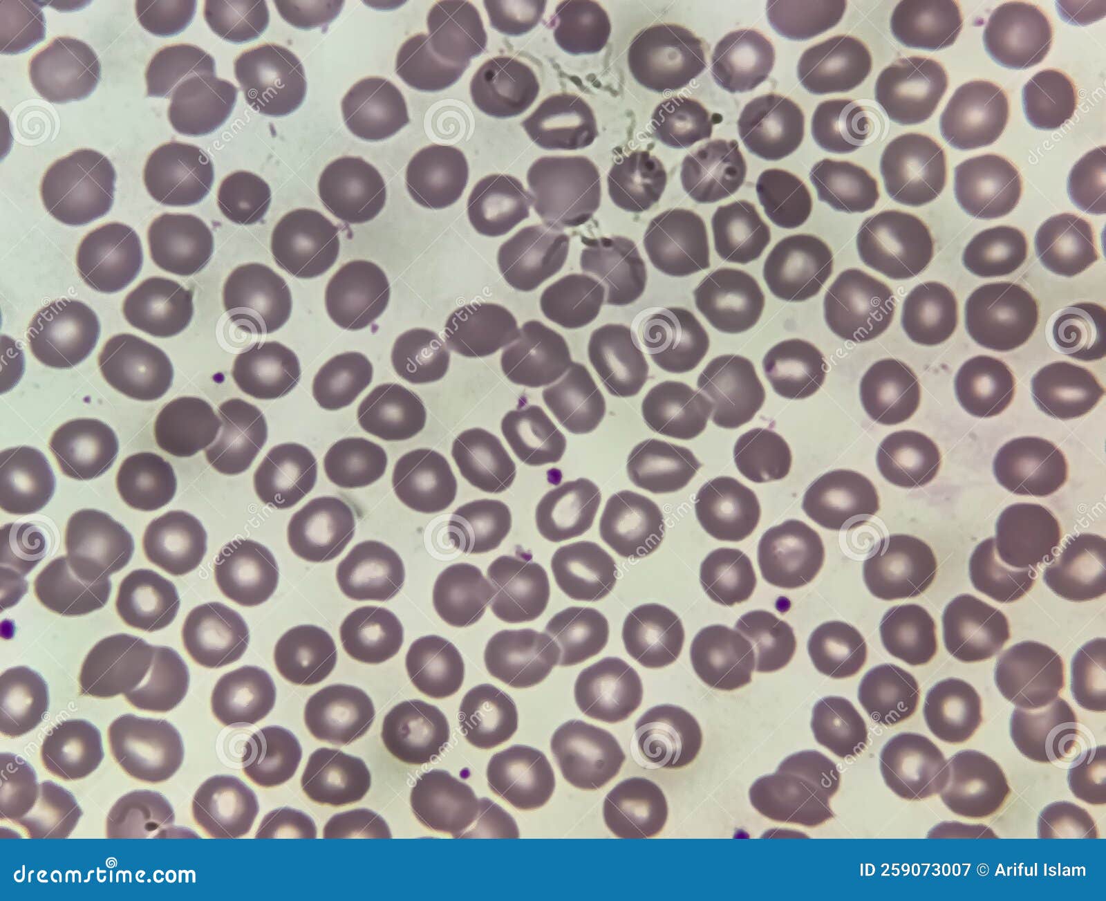 Blood Film Microscopic Show Decrease Platelets Leucocyte (WBC). Stock ...