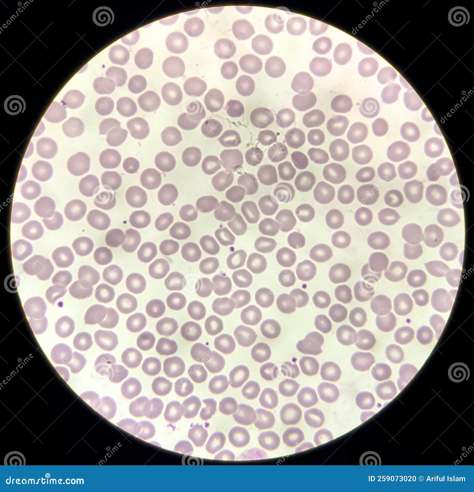 Blood Film Microscopic Show Decrease Platelets Leucocyte (WBC). Stock ...