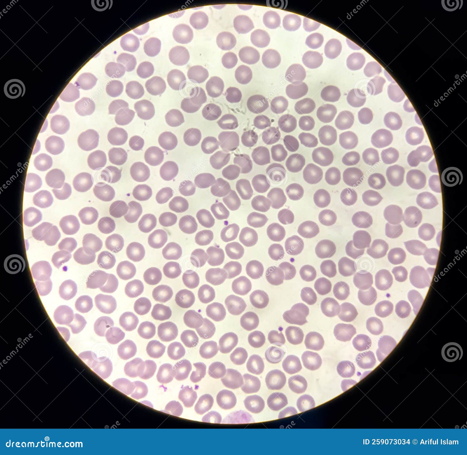 Blood Film Showing A Decrease Of Platelets And White Blood Cells ...