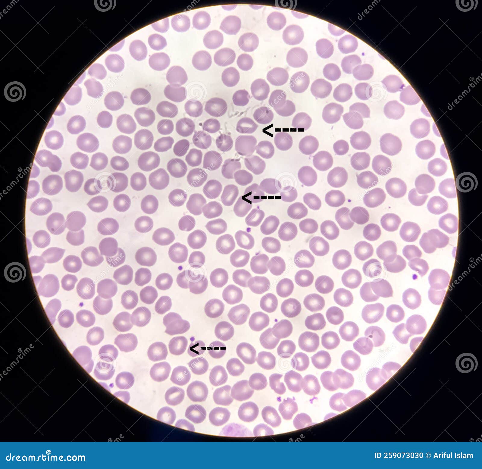 Blood Film Microscopic Show Decrease Platelets Leucocyte (WBC). Stock ...