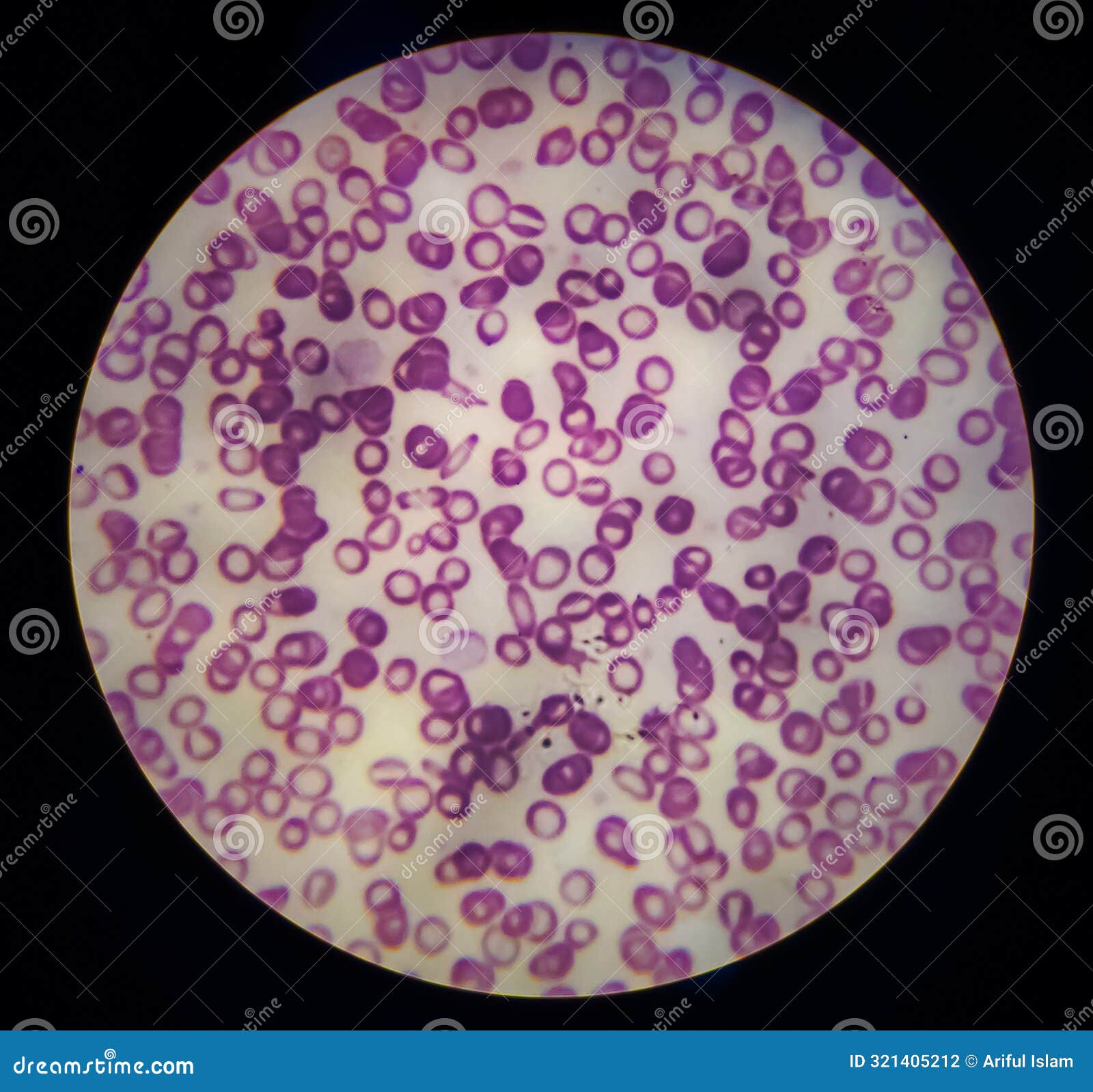 Acute Thrombocytopenia and Leucocytopenia. Stock Photo - Image of ...