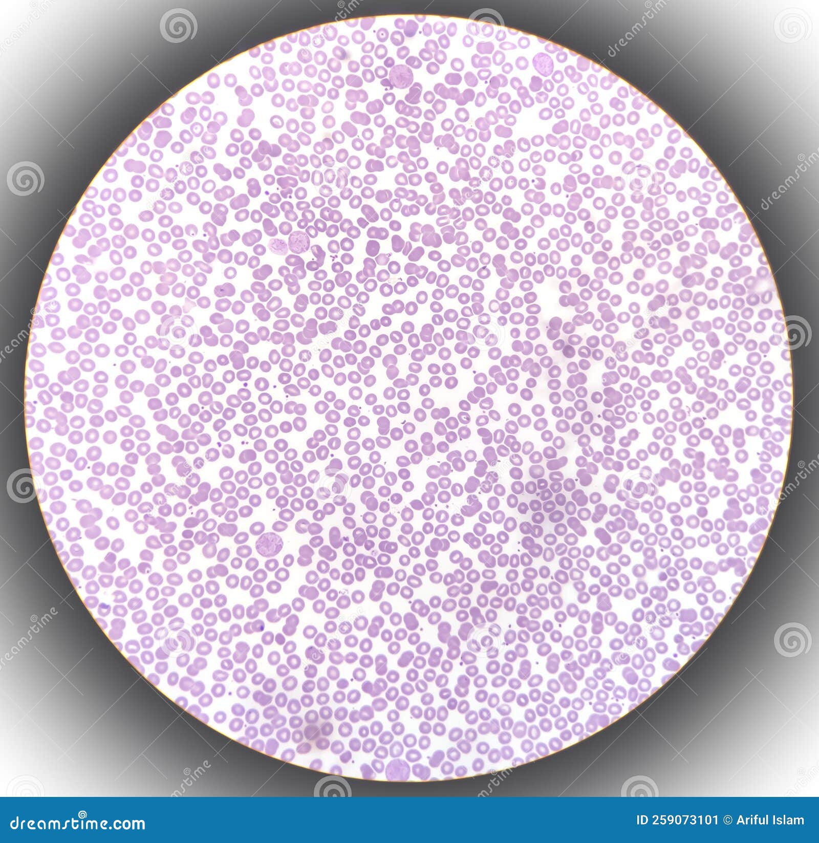 Blood Film Showing a Decrease of Platelets Stock Image - Image of ...