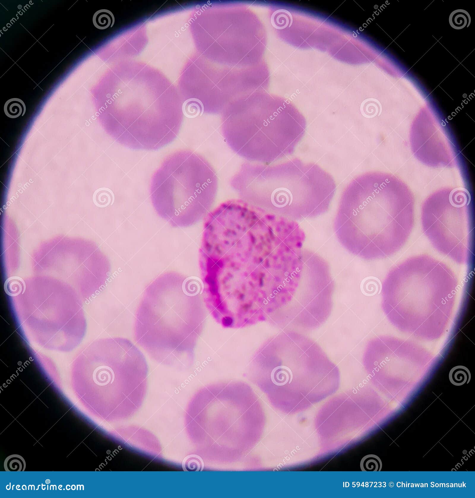 Blood Films for Malaria Parasite. Stock Image - Image of diagnose ...
