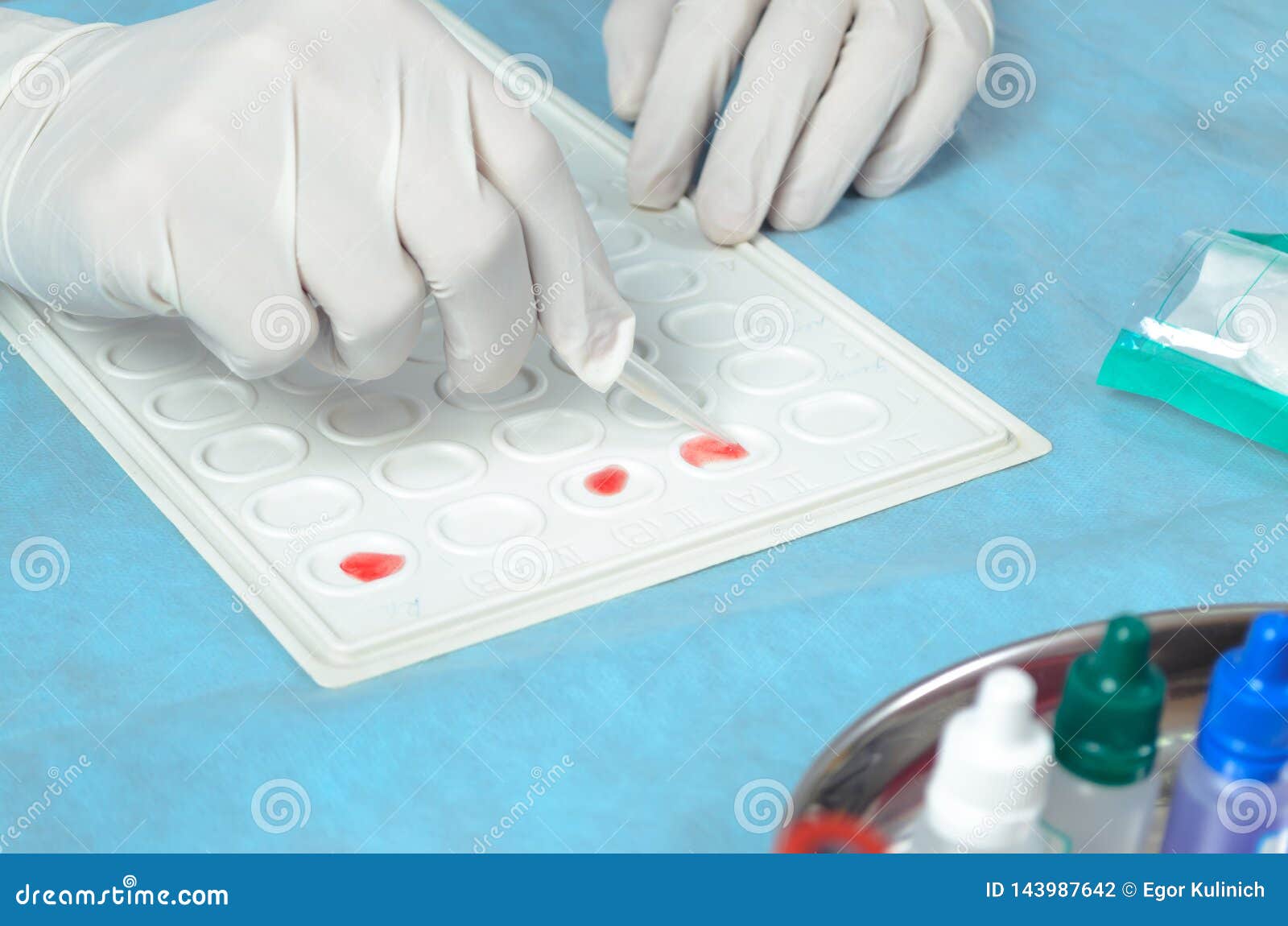 Blood Group and Rh Factor Testing Stock Photo - Image of immunology ...