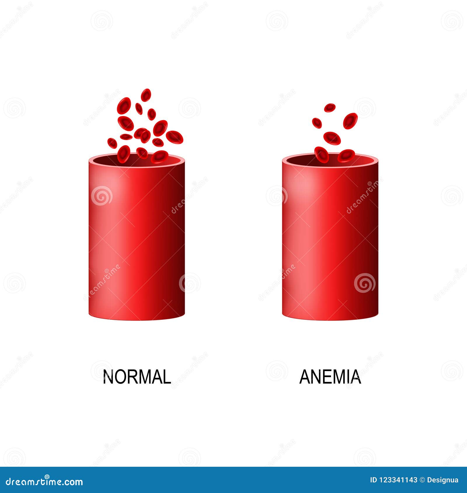 Anemia Diagram Cartoon Vector | CartoonDealer.com #41138243