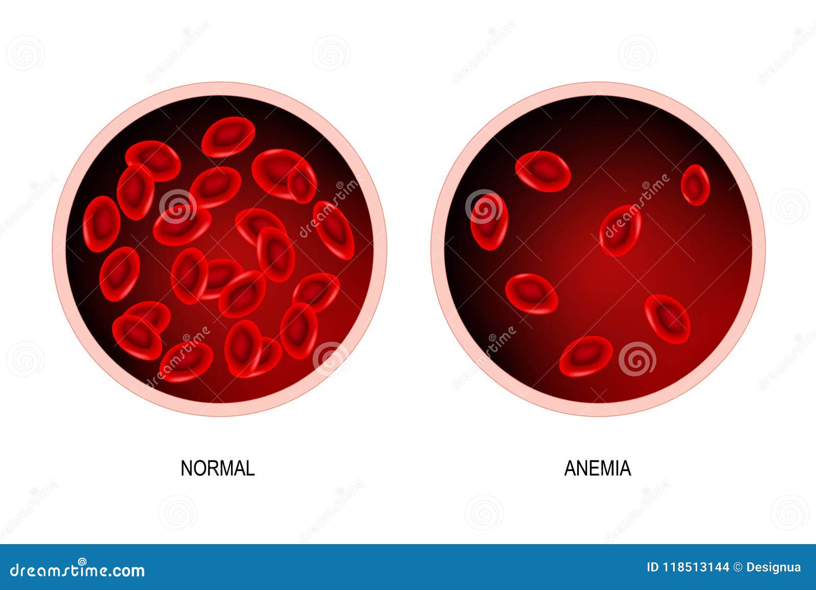 Anemia. Blood of Healthy Human and Blood Vessel with Anemia. Stock ...